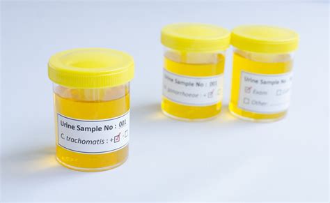 Chlamydia In Men Symptoms Diagnosis Treatments