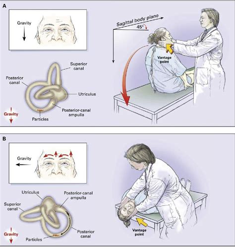 Hallpike Maneuver Illustration