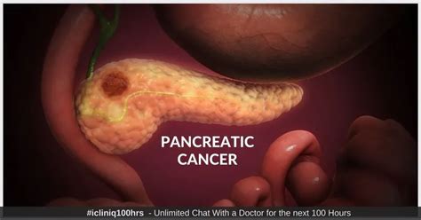 Symptoms Of Stage 4 Pancreatic Cancer