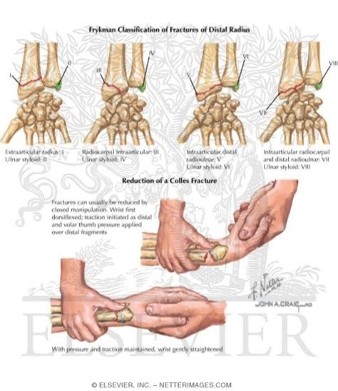 Frykman Classification Of Fractures Of Distal Radius Reduction Of A