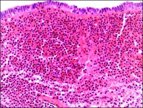 Torsion Of The Testicular Appendix Importance Of Associated Acute
