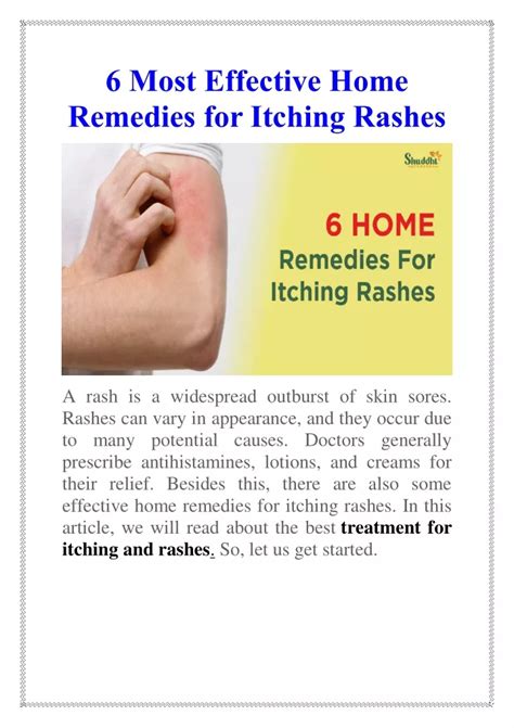 Ppt Home Remedies For Itching Rashes Powerpoint Presentation Free