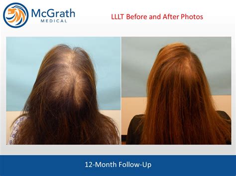 Capillus Laser Hair Therapy Austin Tx Mcgrath Medical