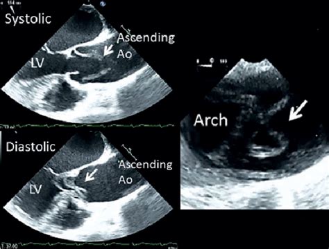 Figure 2 From Intimointimal Intussusception In Both The Proximal And