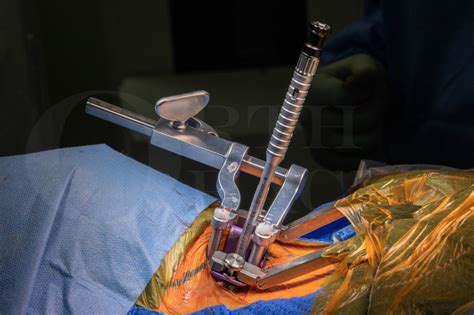 Anterior Cervical Decompression And Fusion Using Globus Coalition Mis