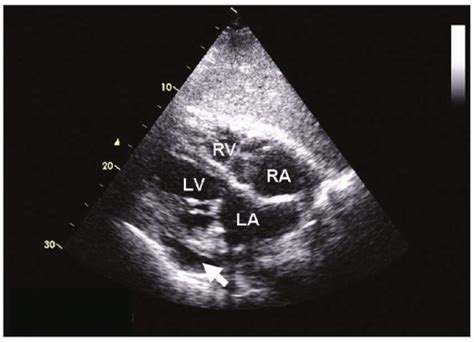 Pericardial Diseases Thoracic Key