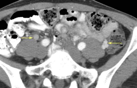 Pelvic Congestion Syndrome Ct Radrounds Radiology Network