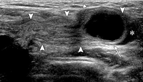 Us Of The Inguinal Canal Comprehensive Review Of Pathologic Processes