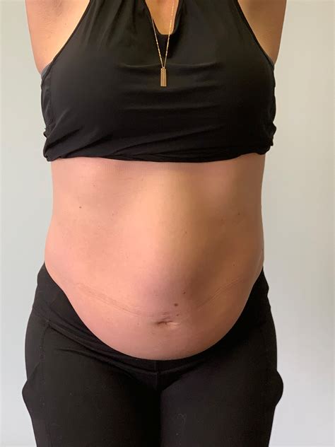 Diastasis Rectus Abdominis Cleveland Oh — Cleveland Chiropractic