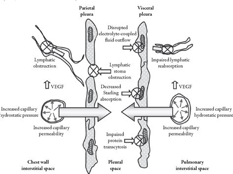 Pathophysiology Of Malignant Pleural Effusion
