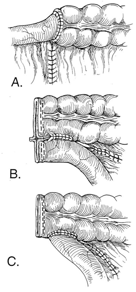 Surgical Management Of Colon And Rectal Cancer Ochsner Journal