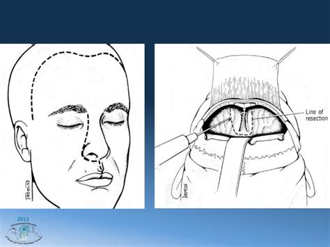 Skull Base Surgery By J Shah Ppt