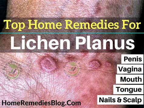 11 Proven Home Remedies To Treat Lichen Planus Naturally Home