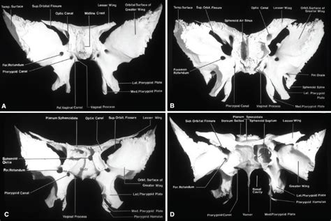 Anatomy Of The Sellar And Parasellar Region Neupsy Key