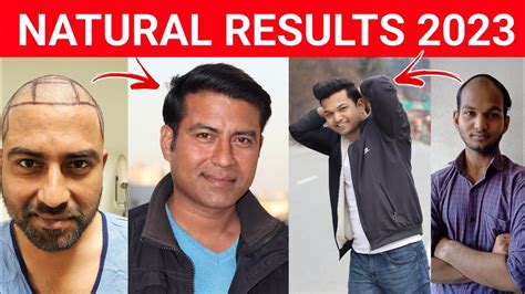 See My Outstanding Hair Transplant Results After 1 Year Best Hair