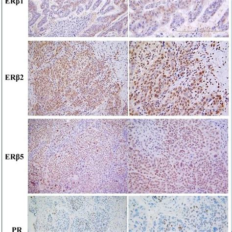 Immunohistochemical Analysis Of Six Hormone Receptors In Primary