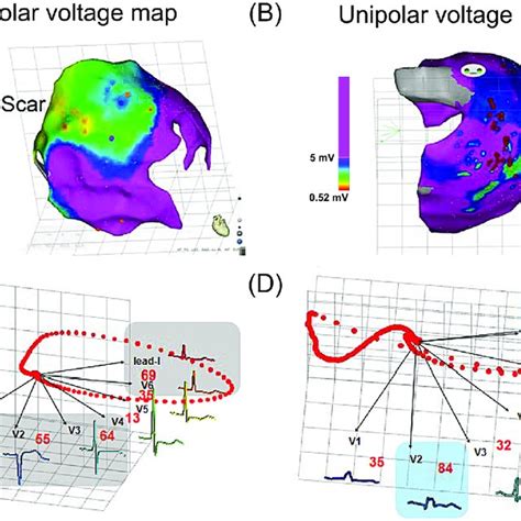 A B 3d Electroanatomic Map And C D Corresponding Reconstruction
