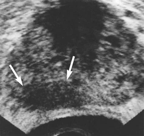 Imaging In Prostate Carcinoma 4 Ultrasonography ~ Urology Notes 2012
