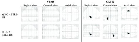 the significant alterations of regional white matter wm volume