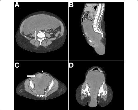 A Axial Contrast Enhanced Computed Tomography Images Shows Subtle
