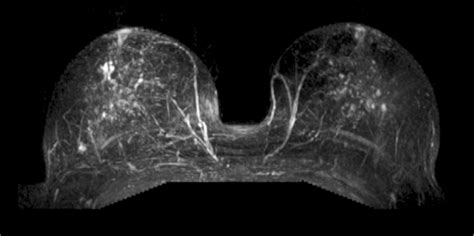 Ductal Carcinoma In Situ And Breast Mri The Lancet