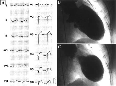 Neurogenic Stunned Myocardium Circulation