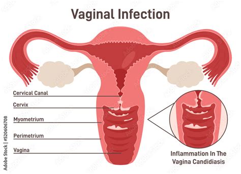 Vaginal Opening Yeast Infection