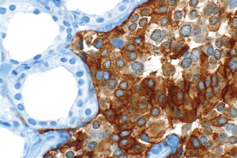 Carcinoembryonic Antigen Libre Pathology