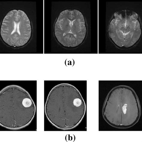 mri brain tumor detection using optimal possibilistic