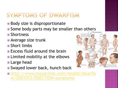 Ppt Dwarfism Powerpoint Presentation Free Download Id 2211297