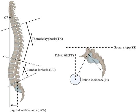 Illustration Of Various Spine Pelvic Parameters Sva Sagittal Vertical