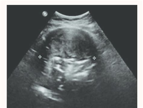 Patient Number 1 Transvaginal Ultrasound Enlarged Uterus 16 9 Cm X
