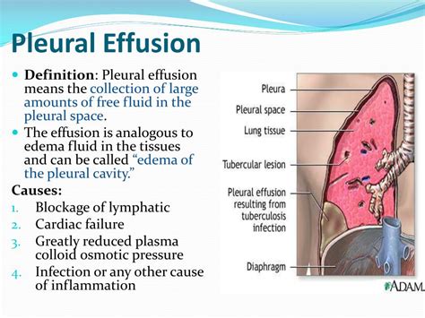 Ppt Chapter 38 Pulmonary Circulation Pulmonary Edema Pleural Fluid