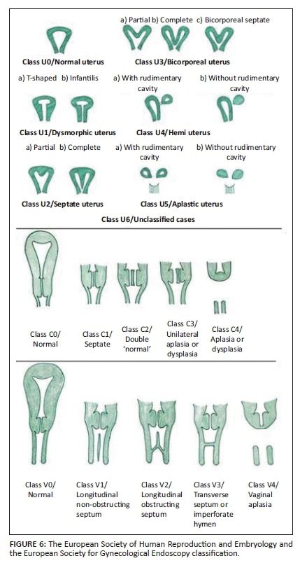 Magnetic Resonance Imaging Of Classified And Unclassified Müllerian
