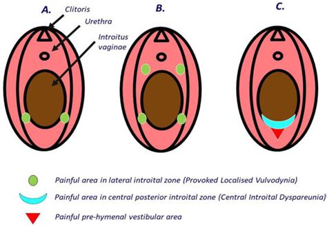 Jcm Free Full Text Long Term Outcome Of Surgical Treatment Of