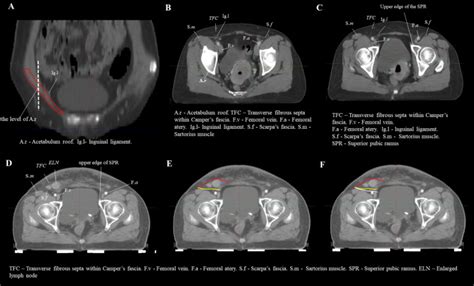 Inguinal Nodal Clinical Target Volume Delineation Based On Analysis Of