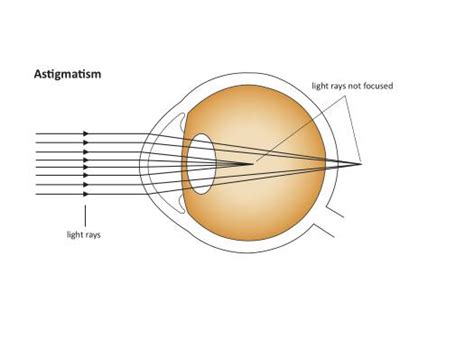 Astigmatism Correcting Iols Cataract Surgery Information