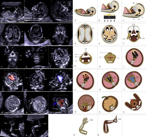 Routine First Trimester Ultrasound Screening Using A Standardized