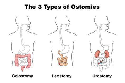 What Is A Stoma – Ostomy Health Blog