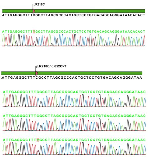 Chromatogram Of The Proband With The Top Panel Depicting A Missense