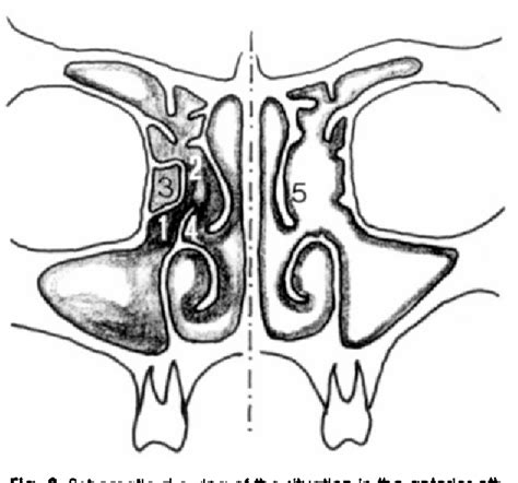 Sphenoid Sinusitis Semantic Scholar