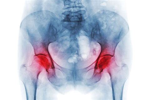 Bone Infection What Is A Bone Infection