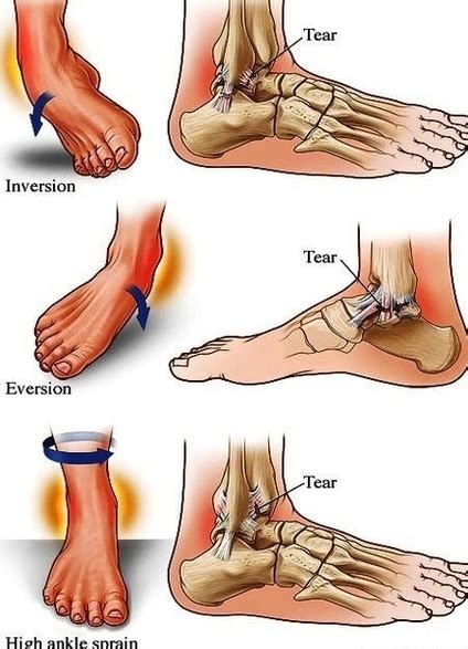 Types Of Ankle Sprains Image Graph Diagram
