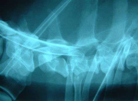 Bone Tumors Ulnar Dr Julius Liptak