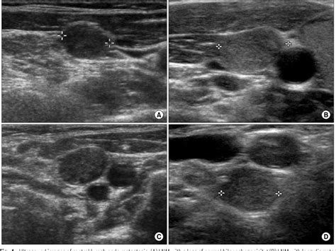 Figure 1 From Prophylactic Central Lymph Node Dissection In Patients