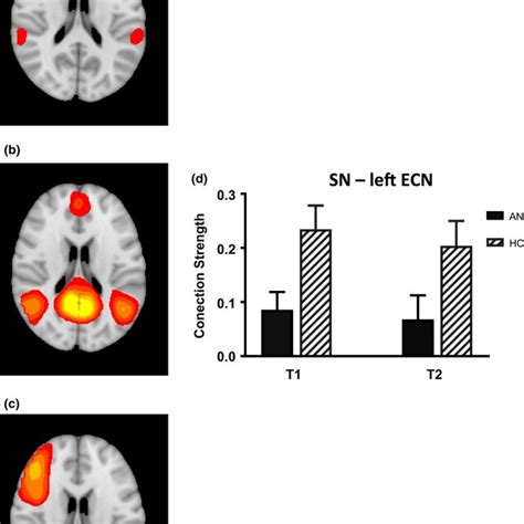 Functional Connectivity Analysis Shows Reduced Connectivity Between The