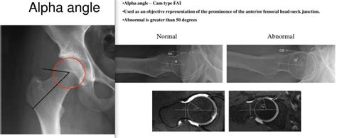 Alpha Angle Notzli Angle Formed By The Axis Of The Femoral Neck And