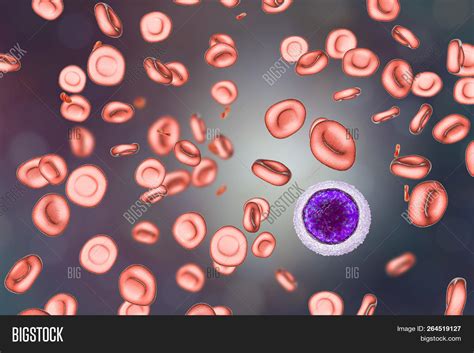 Iron Deficiency Anemia Under Microscope