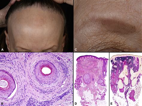 Lichen Planus And Lichenoid Dermatoses Journal Of The American