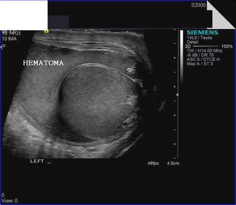 Testicular Rupture Ultrasound